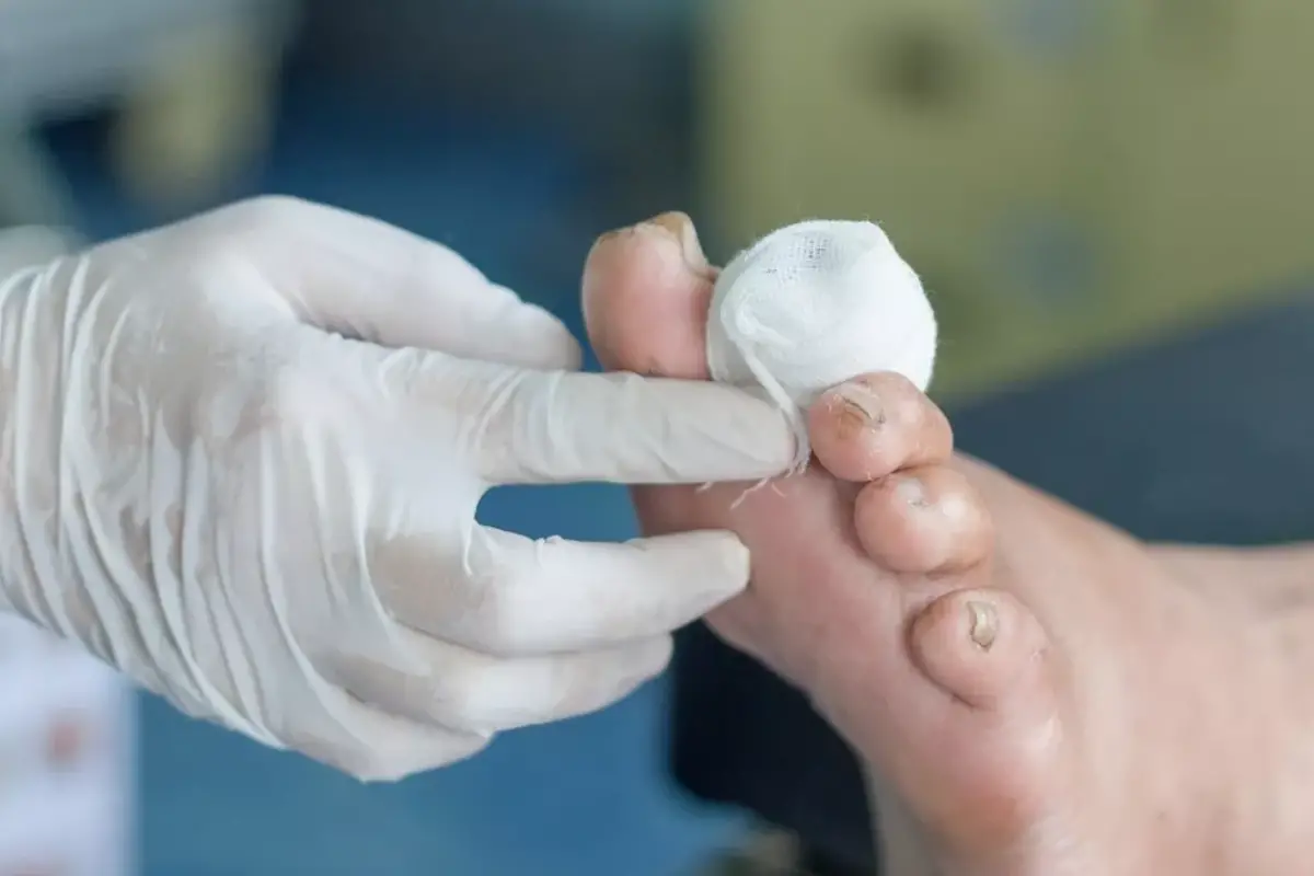 Feridas diabéticas: 3 tipos principais e formas de tratar