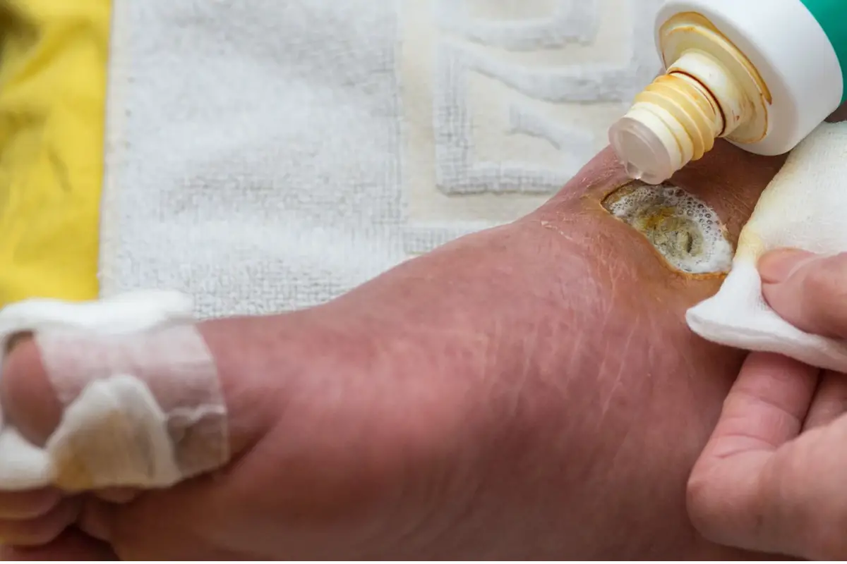 Feridas de diabetes: Conheça os 3 tipos principais